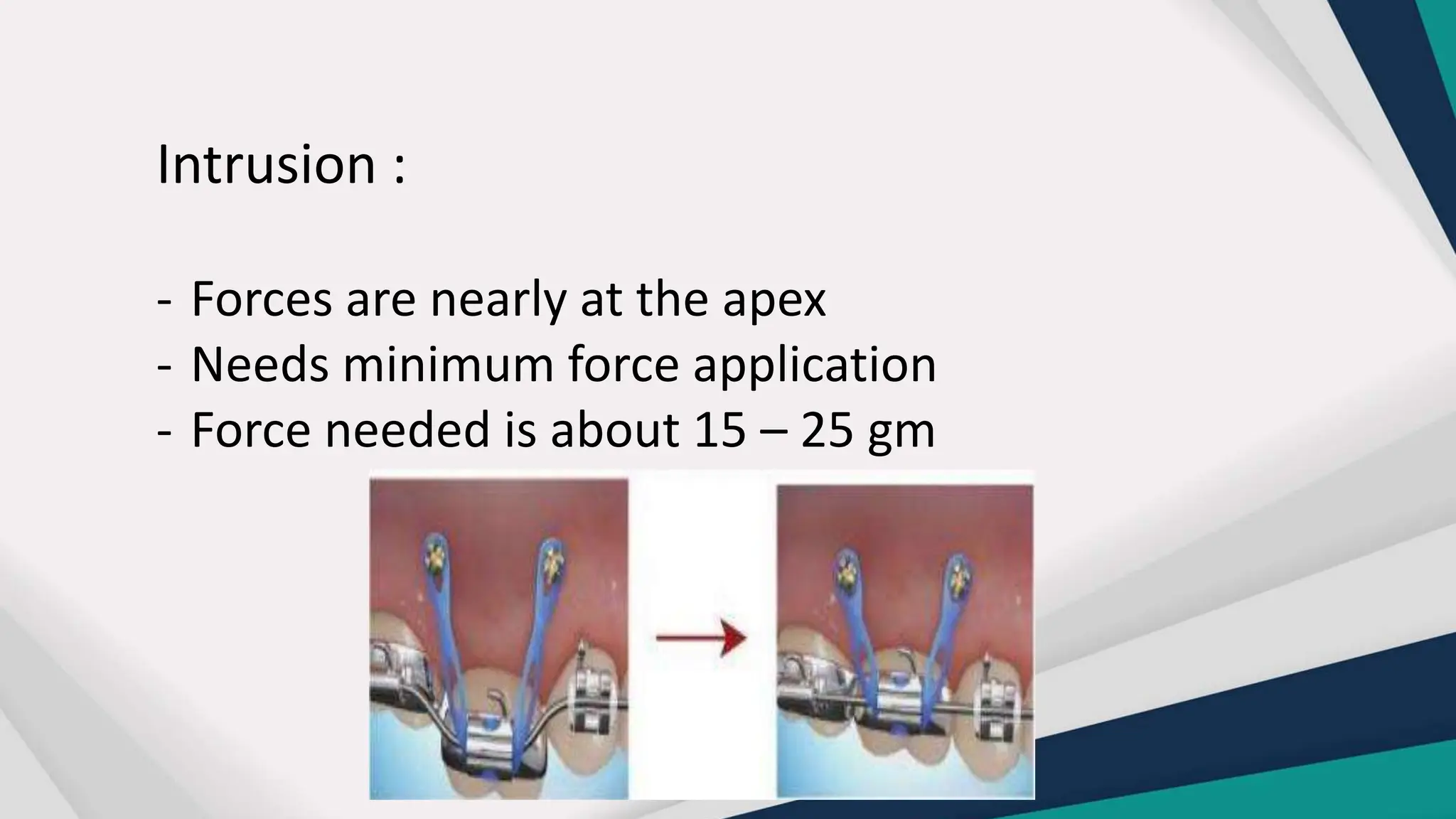 Types of tooth movement orthodontic.pptx