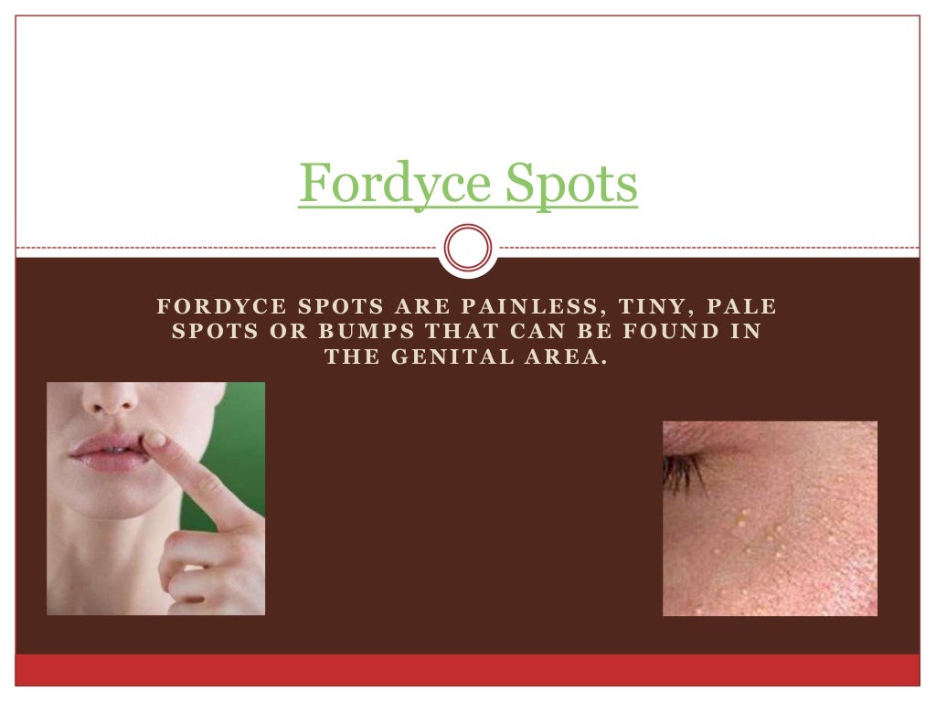 Pearly Penile Papules On Shaft