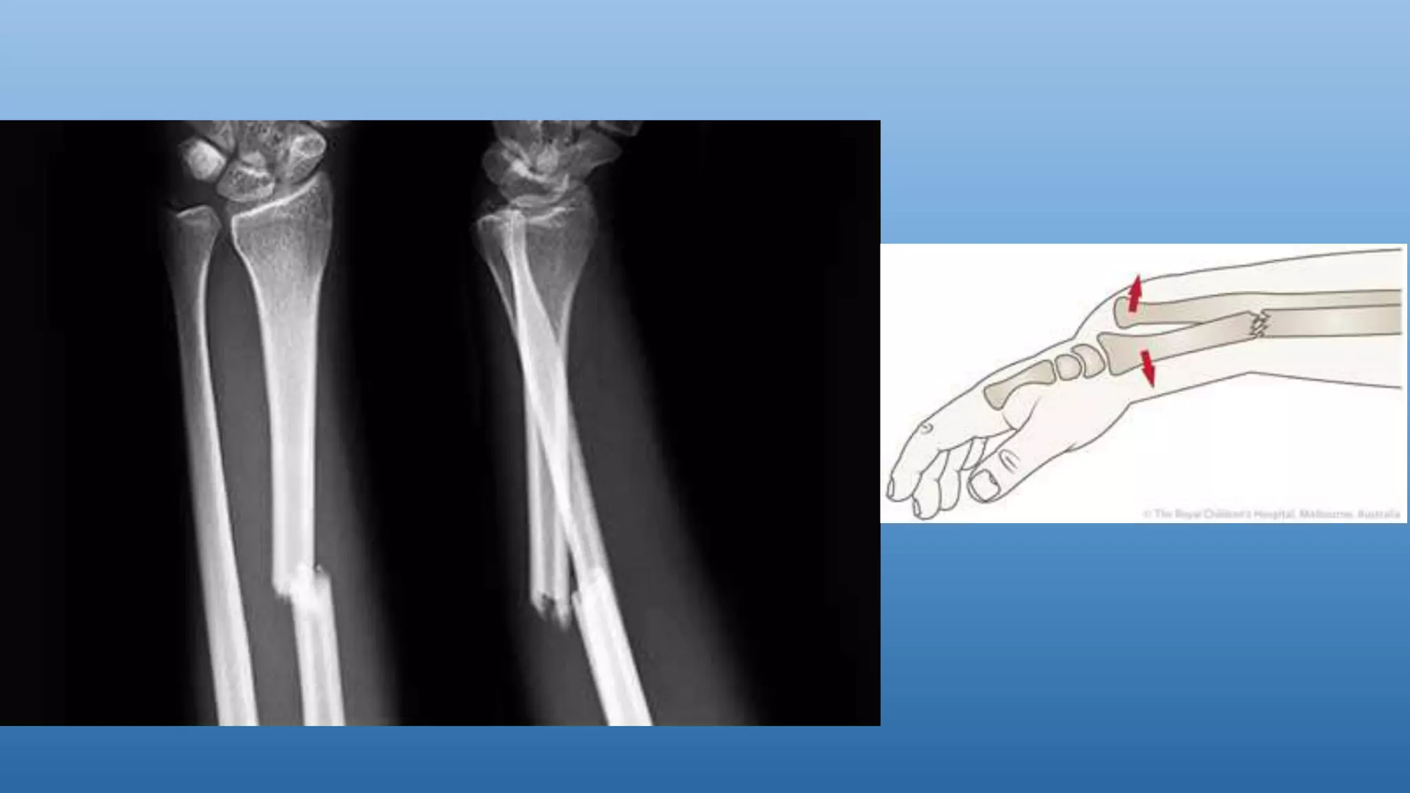 Forearm fractures | PPTX