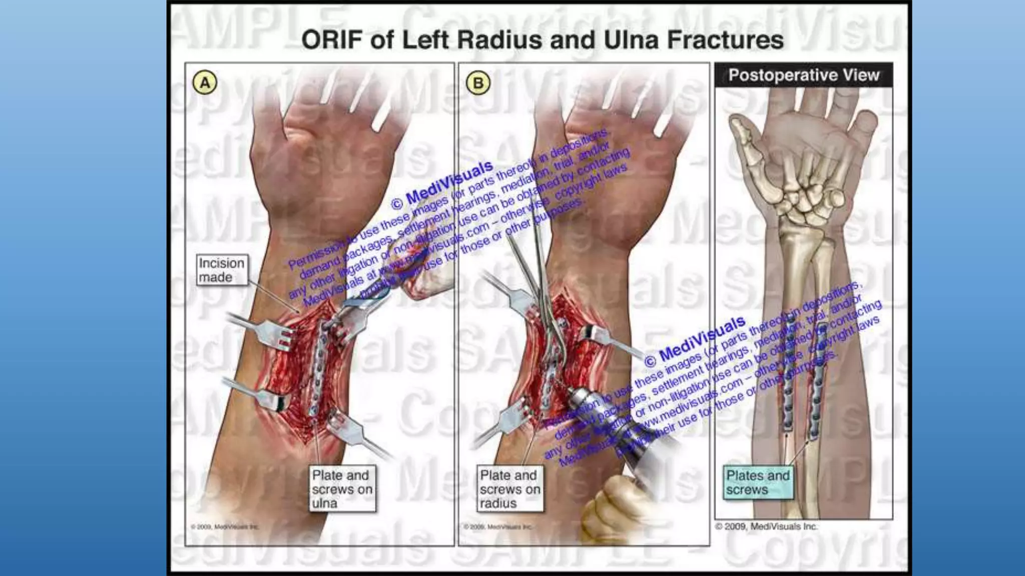 Forearm fractures | PPTX