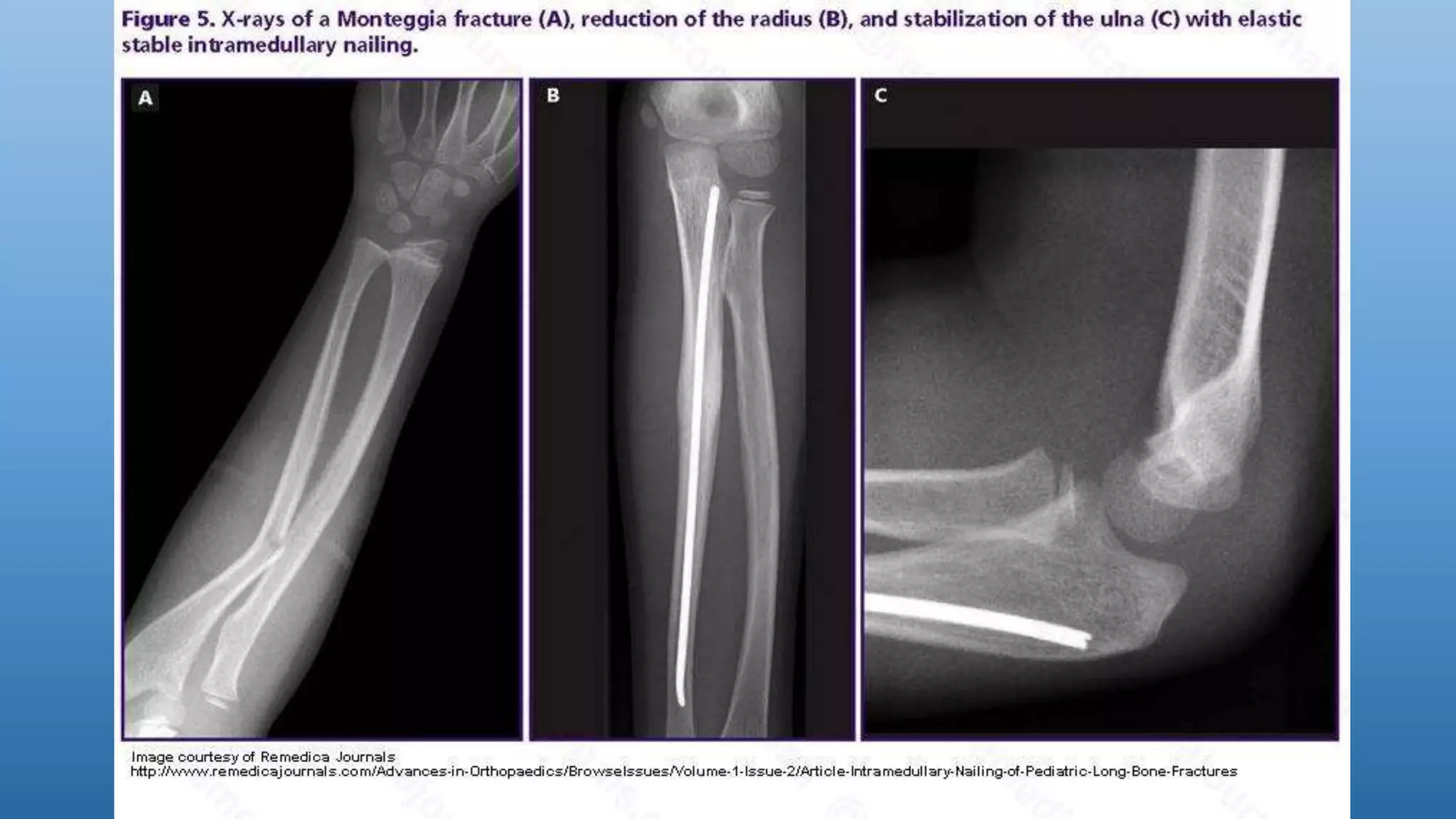 Forearm fractures | PPTX
