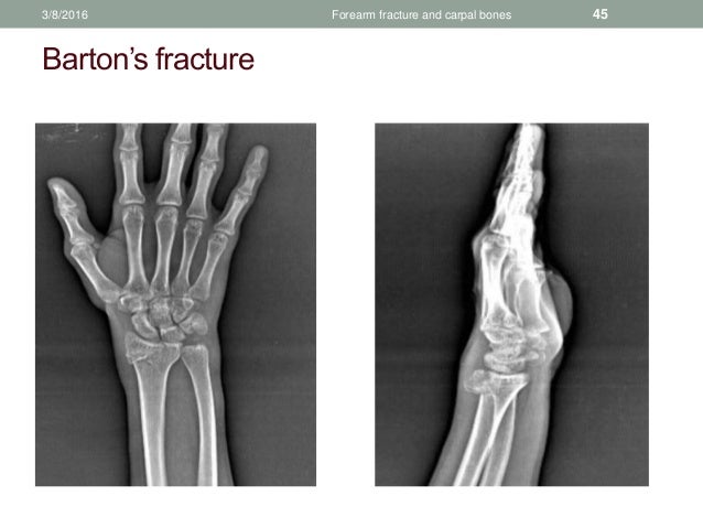 # Forearm and carpal bones