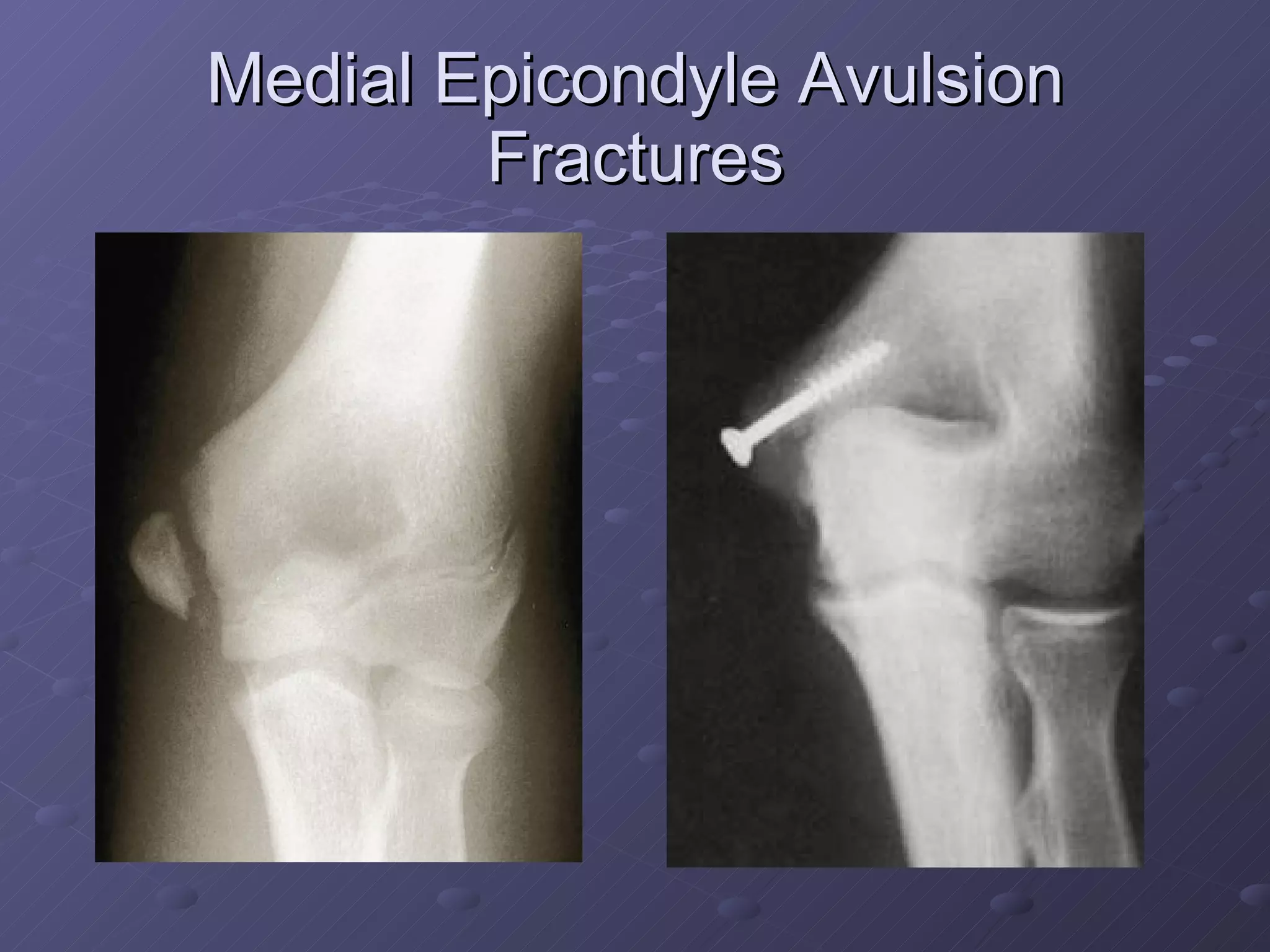 Forearm And Elbow Pathologies Dr. Mark Davies Sjsu, Spring 2008 | PPT