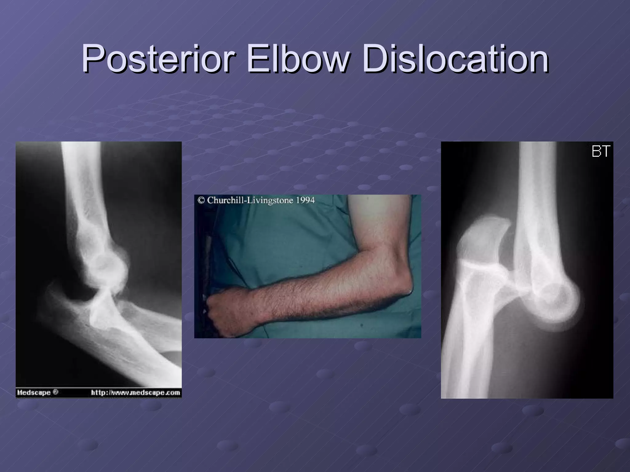 Forearm And Elbow Pathologies Dr. Mark Davies Sjsu, Spring 2008 | PPT