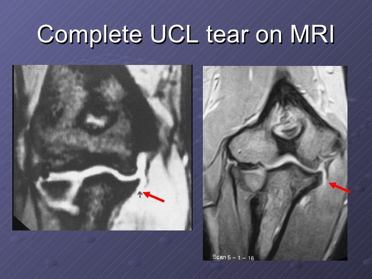 Forearm And Elbow Pathologies Dr. Mark Davies Sjsu, Spring 2008