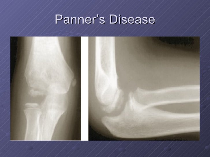 Forearm And Elbow Pathologies Dr. Mark Davies Sjsu, Spring 2008