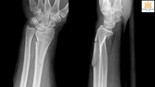 Forearm fracture, A Wednesday child in upper extremity fracture | PDF