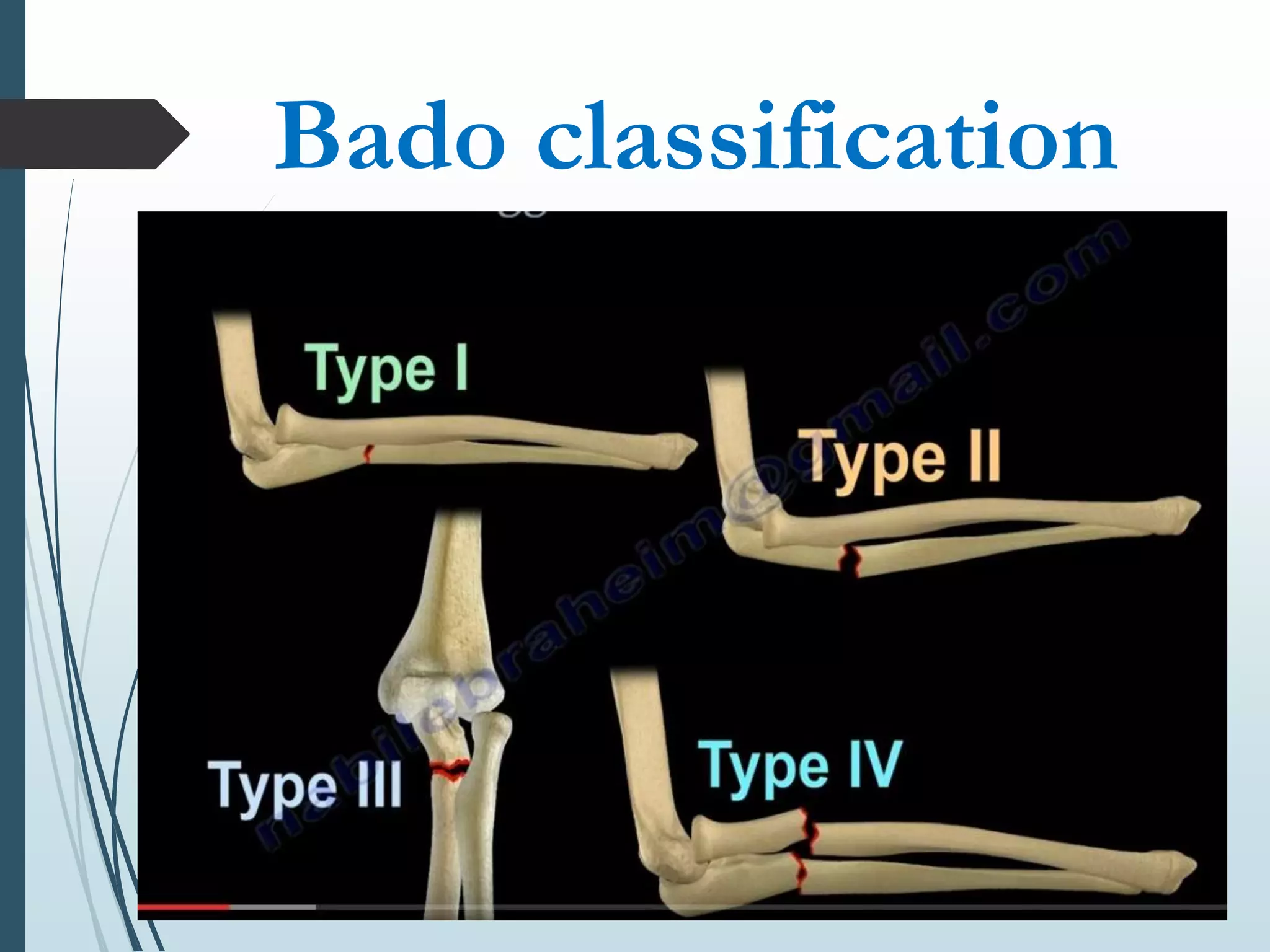 Forearm Fractures- Dr Sundar Karki.pptx