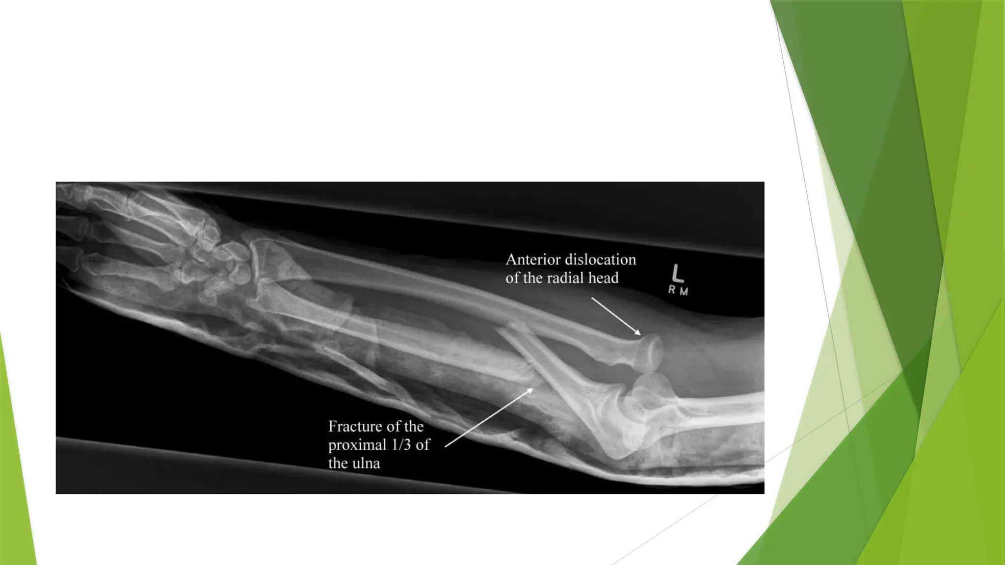 FOREARM_FRACTURES[1].pptx and management | PPTX