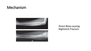 Forearm Fractures of Adults | PPTX