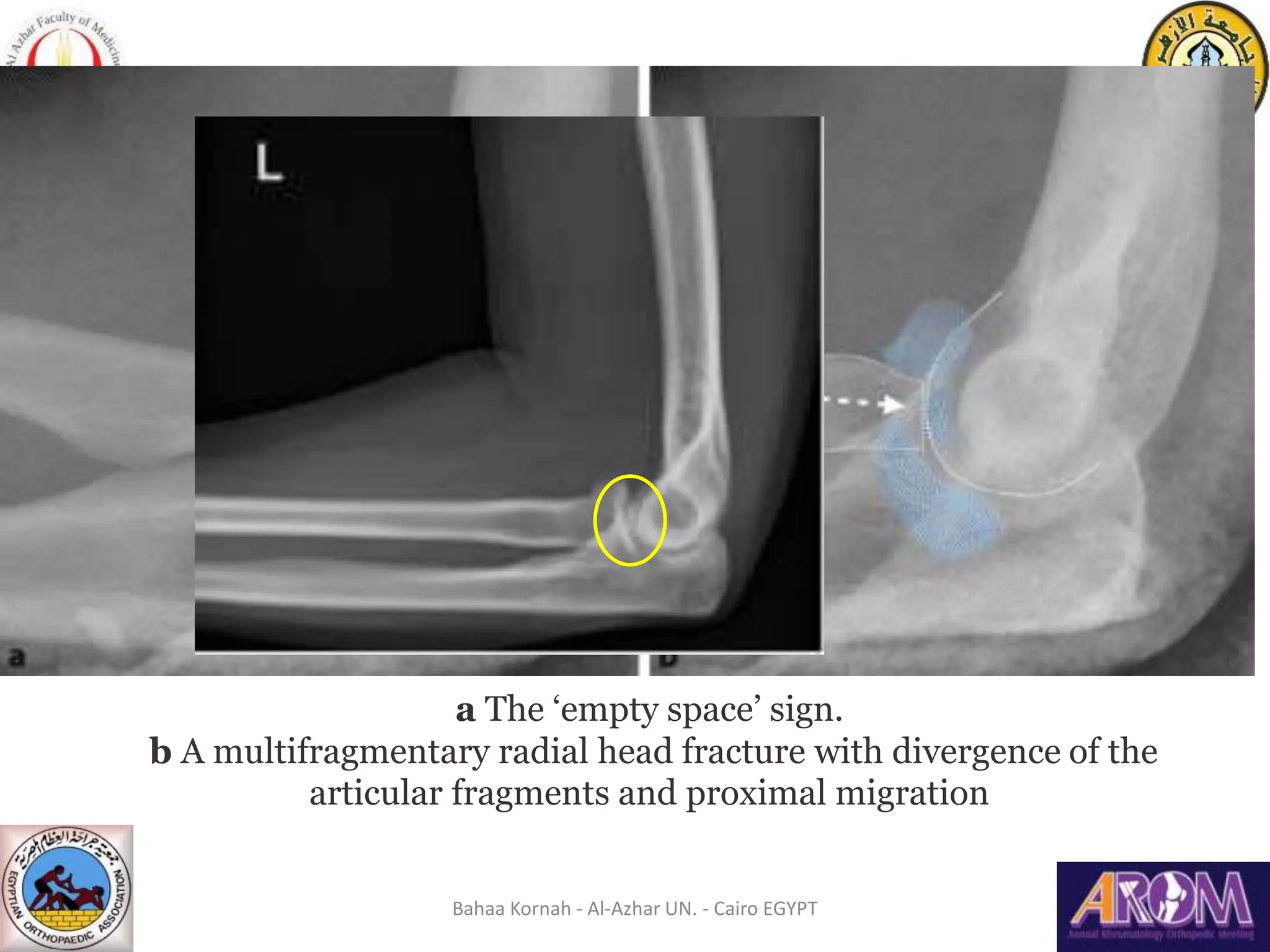 Forearm instability | PPT