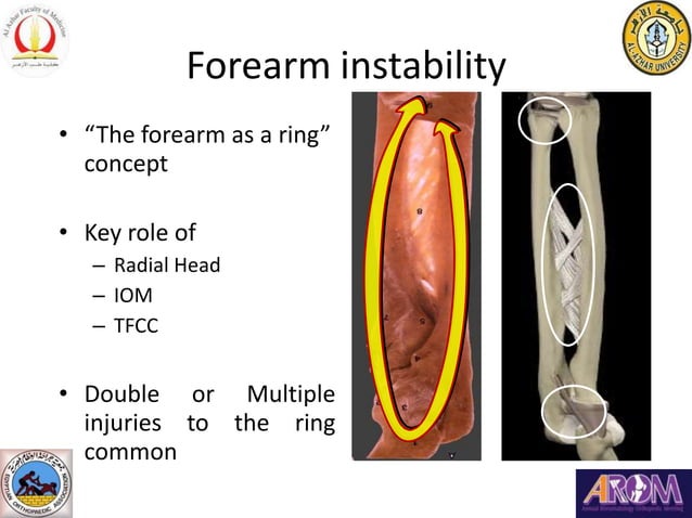 Forearm instability | PPT