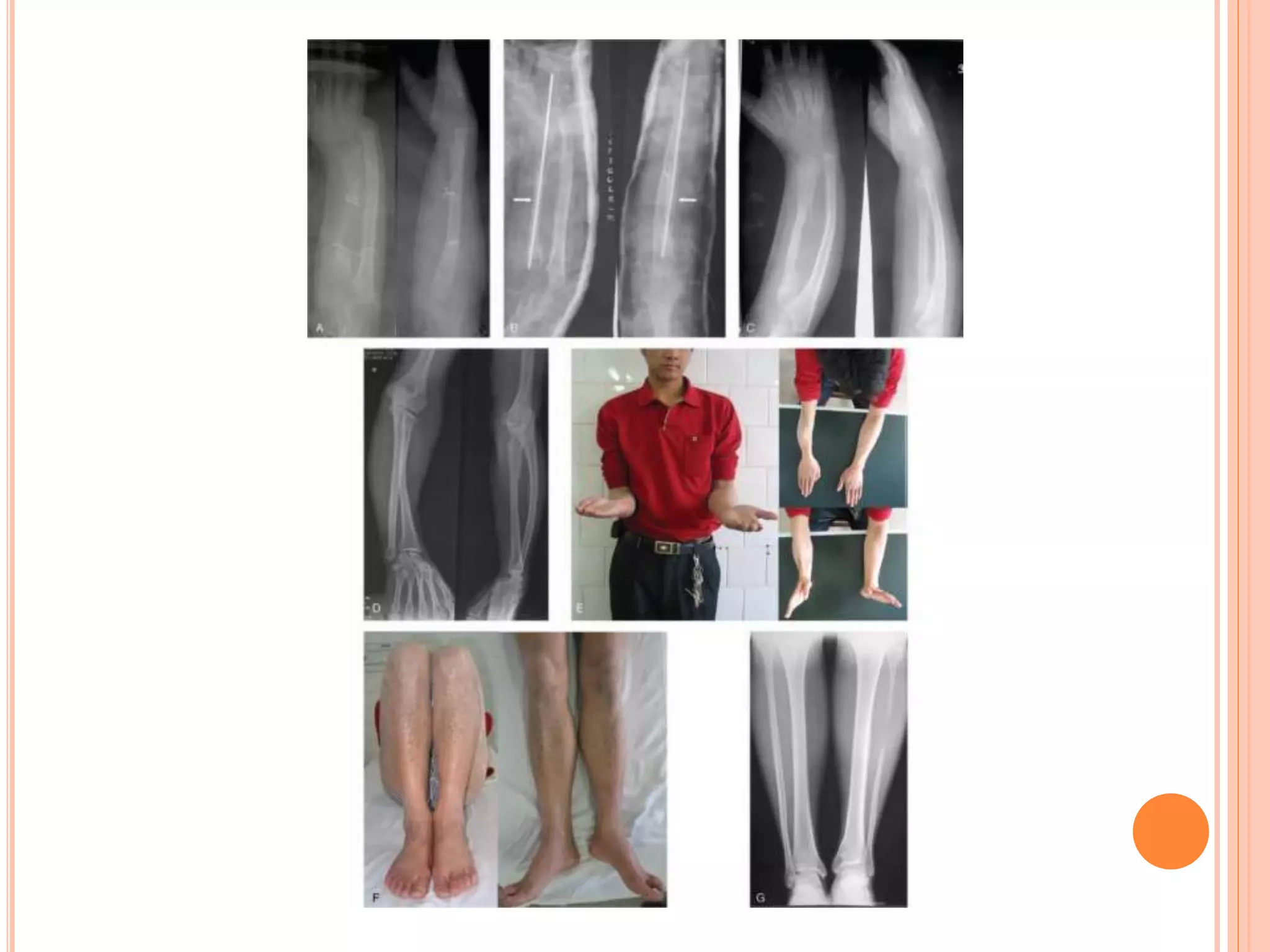 Forearm reconstruction | PPTX