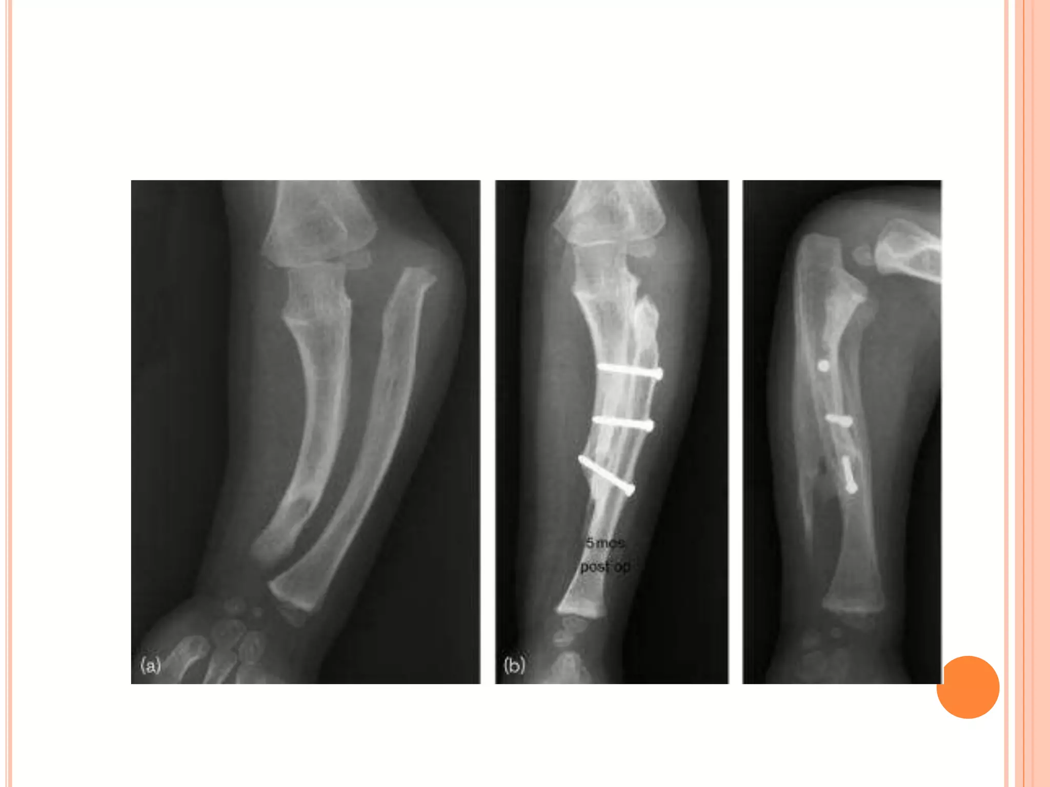 Forearm reconstruction | PPTX