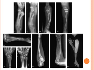 Forearm reconstruction | PPTX