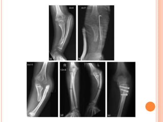Forearm reconstruction | PPTX