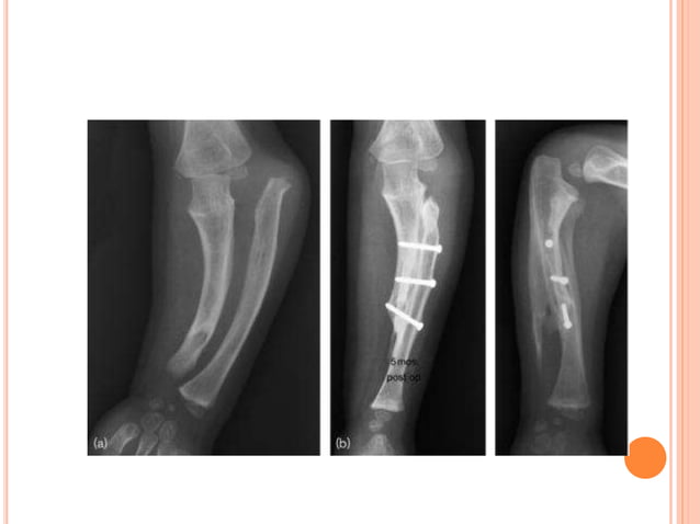 Forearm reconstruction | PPT