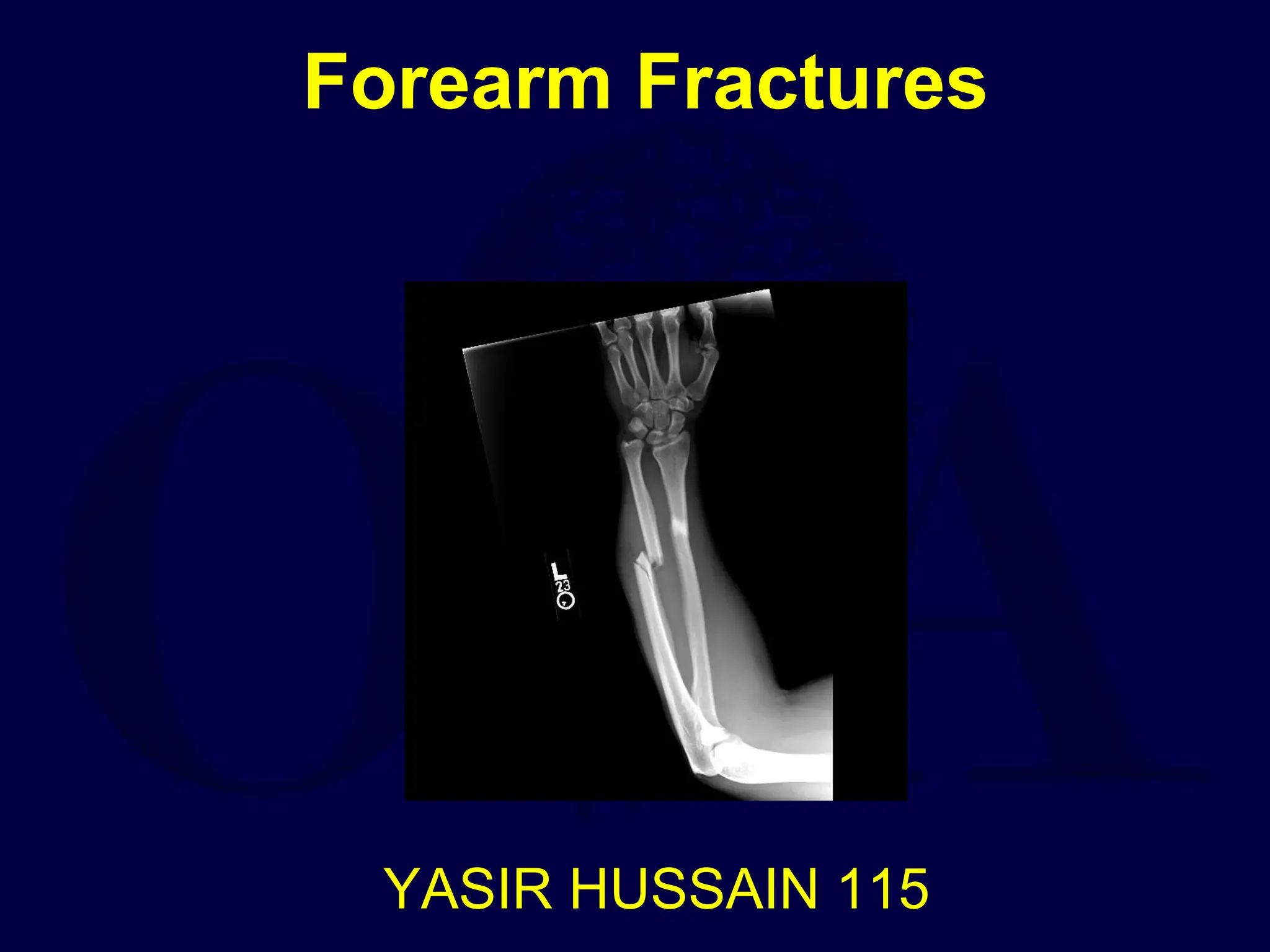 FOREARM TRAUMA. .pptx. | PPTX