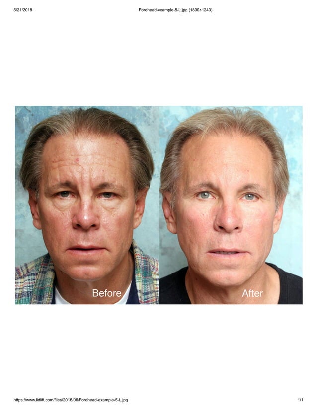 Forehead Lift | PDF