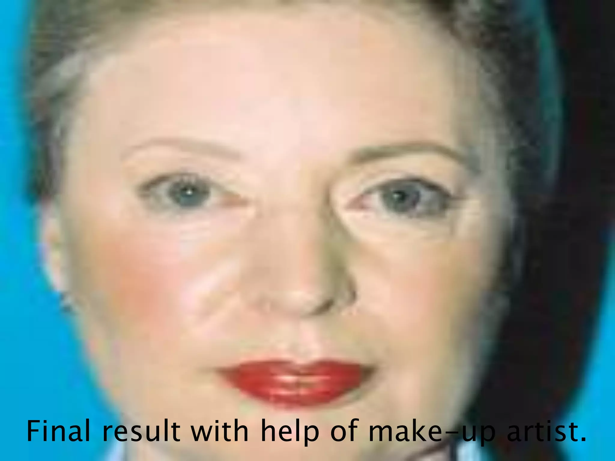 Forehead defects reconstruction | PPTX