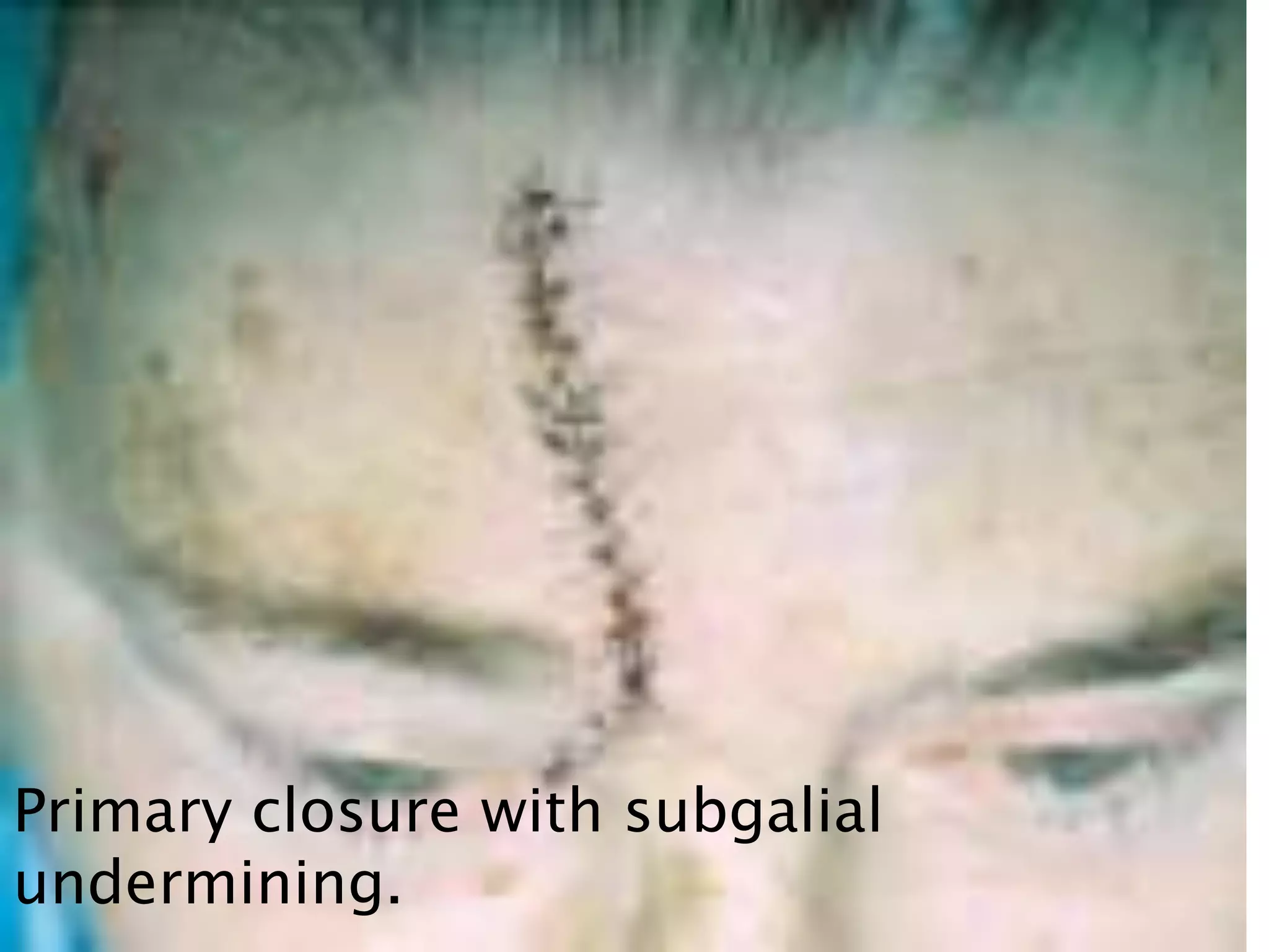 Forehead defects reconstruction | PPTX