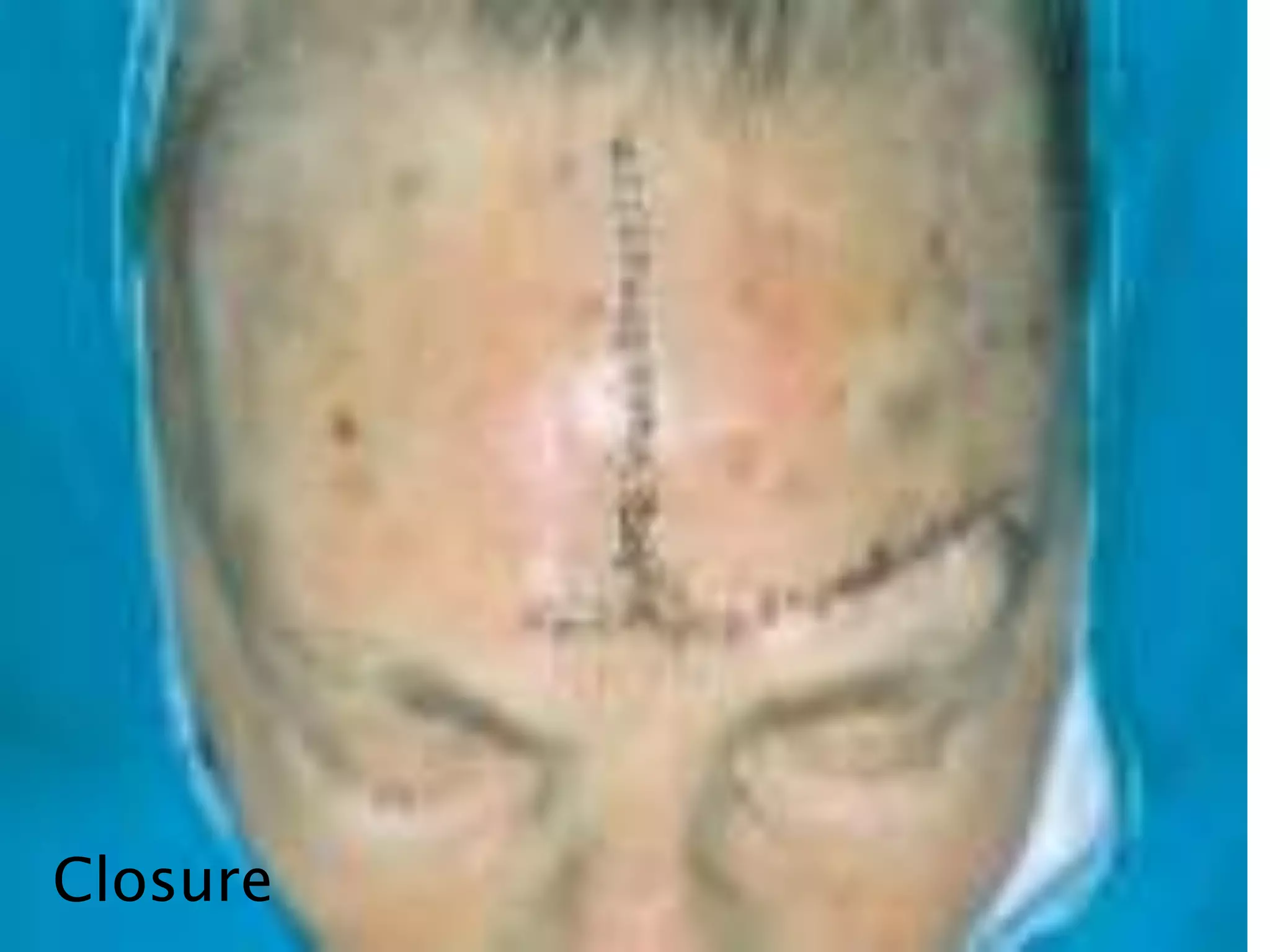 Forehead defects reconstruction | PPTX