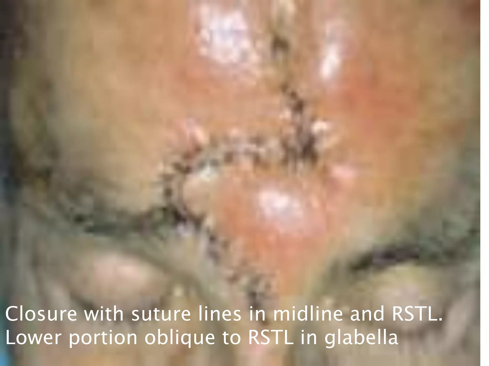 Forehead defects reconstruction | PPTX