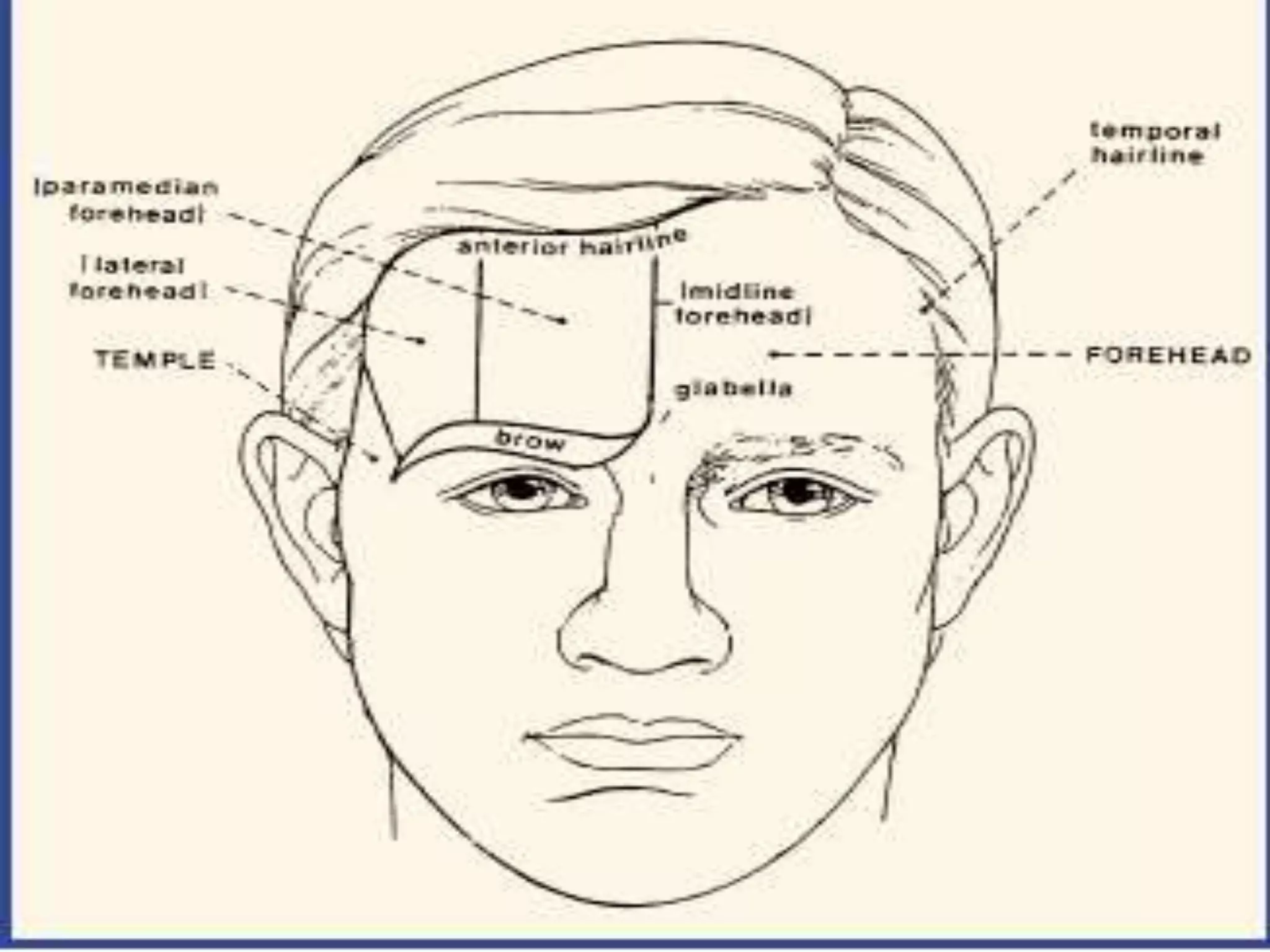 Forehead defects reconstruction | PPTX