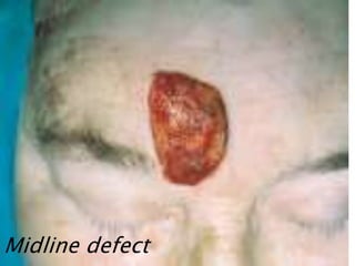 Forehead defects reconstruction | PPTX