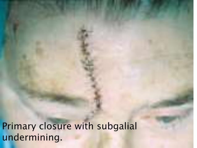 Forehead defects reconstruction | PPTX | Death, Injury, or Military ...