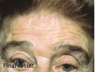 Forehead defects reconstruction | PPTX