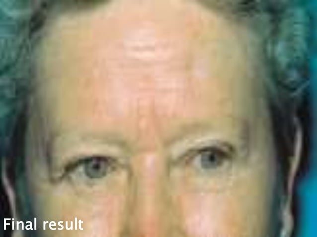 Forehead defects reconstruction | PPTX | Death, Injury, or Military ...