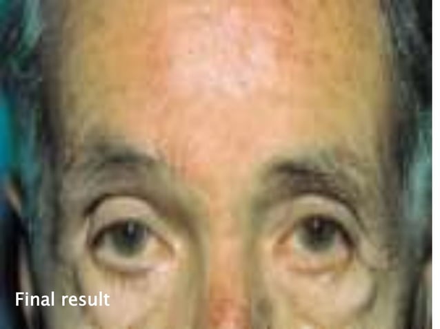 Forehead defects reconstruction | PPT