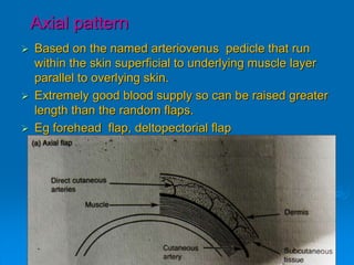 Forehead flap | PPTX