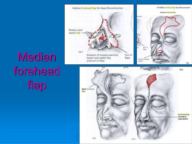 Forehead flap