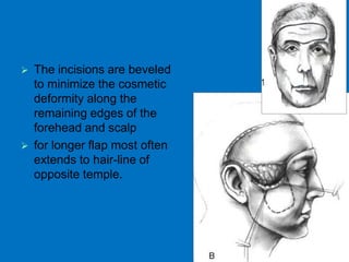 forehead flap ppt.pptx