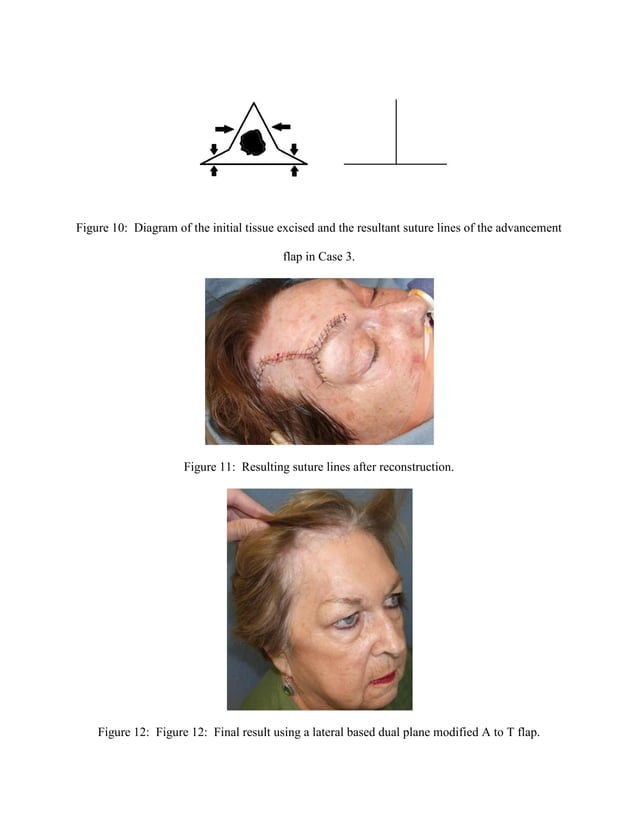 Forehead Reconstruction Using an A to T | PDF