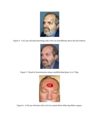 Forehead Reconstruction Using an A to T | PDF