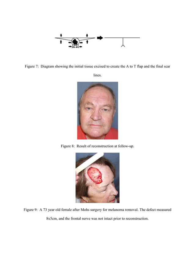 Forehead Reconstruction Using an A to T | PDF