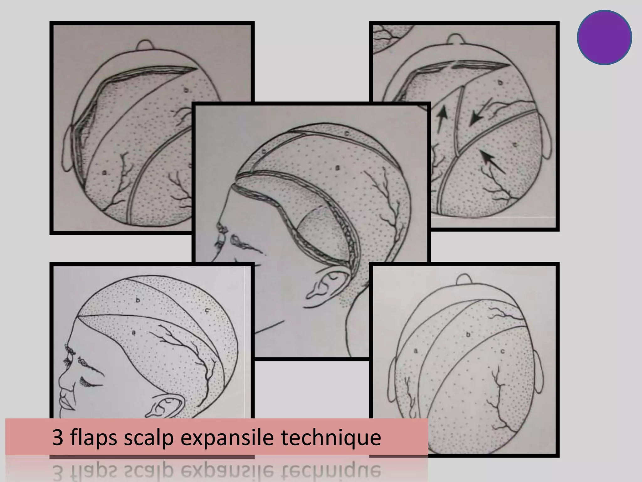 Forehead reconstructionn | PPTX
