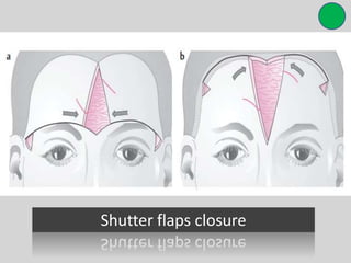 Forehead reconstructionn | PPTX