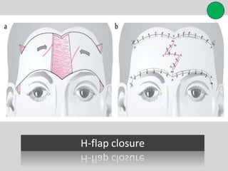 Forehead reconstructionn | PPTX