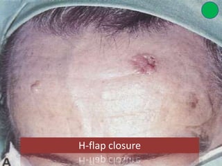 Forehead reconstructionn | PPTX