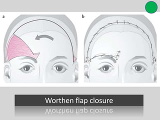 Forehead reconstructionn | PPTX