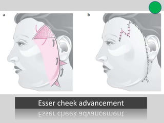 Forehead reconstructionn | PPTX