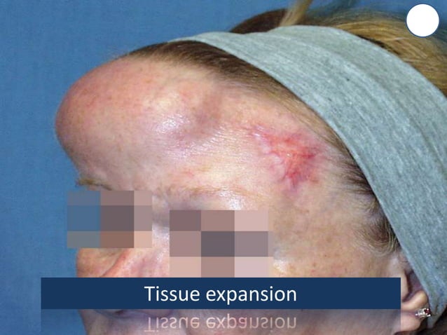 Forehead reconstructionn | PPTX