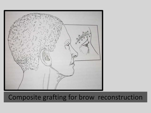 Forehead reconstructionn | PPTX