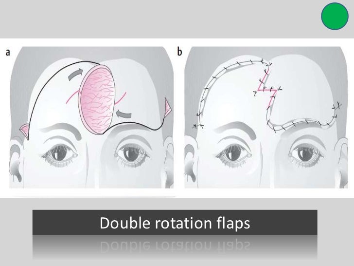 Forehead reconstructionn