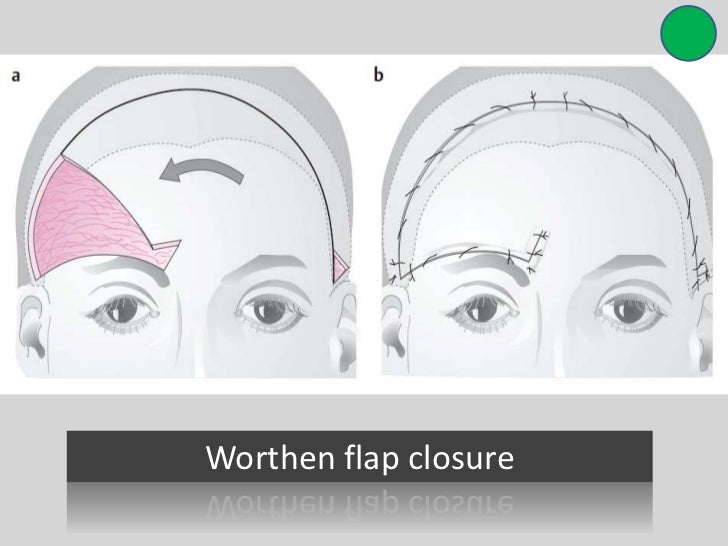 Forehead reconstructionn