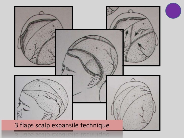 Forehead Reconstructionn